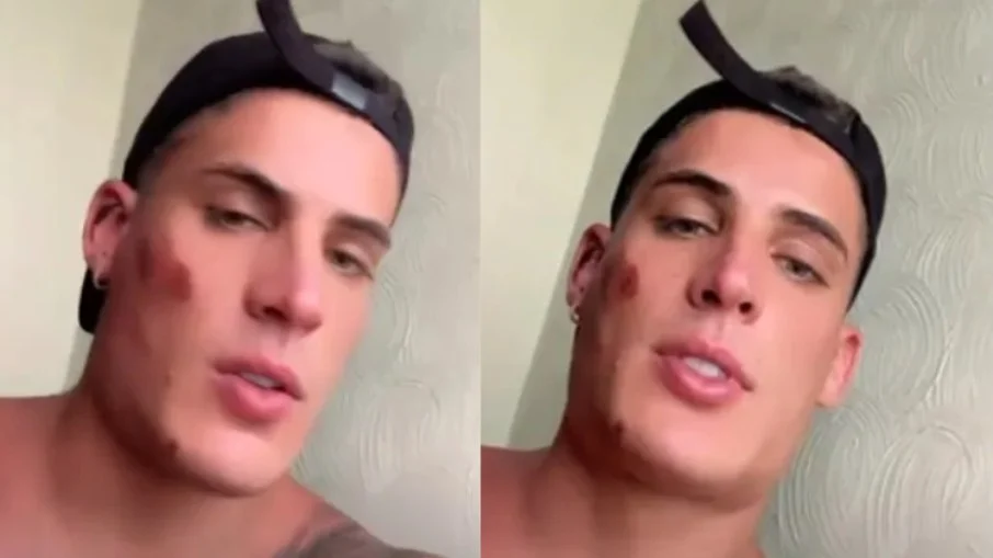 Com rosto machucado, Tiago Ramos explica vídeo de briga: 'Me ameaçou ...