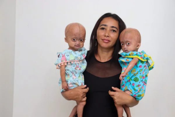 Conheça as gêmeas brasileiras com síndrome de Benjamin Button ...