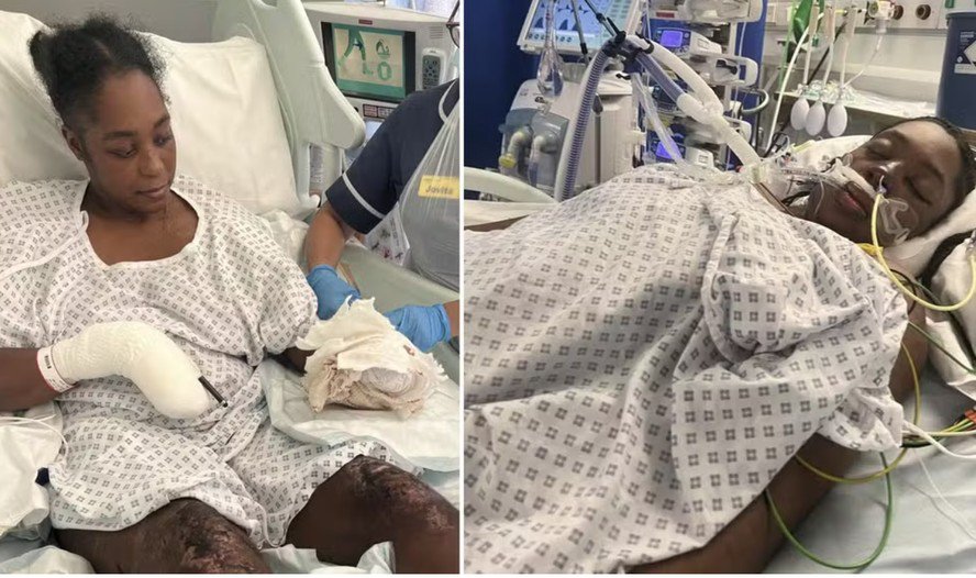 Mãe de gêmeos sofre infecção pós-parto e tem pernas e braço amputados ...