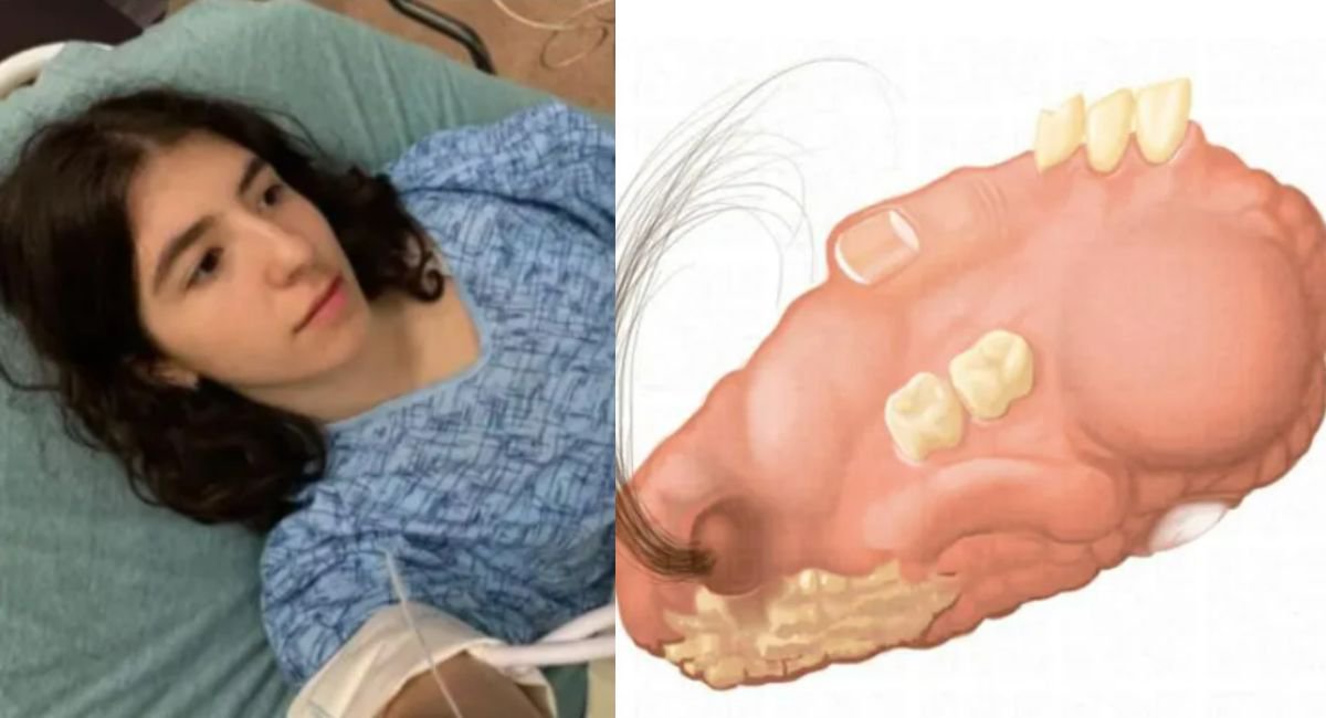 Adolescente de 17 anos descobre um raro tumor com dente e olho afetando ...
